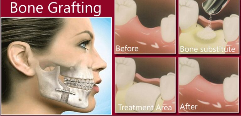 Bone Grafts & Sinus Lift | Aria Dental
