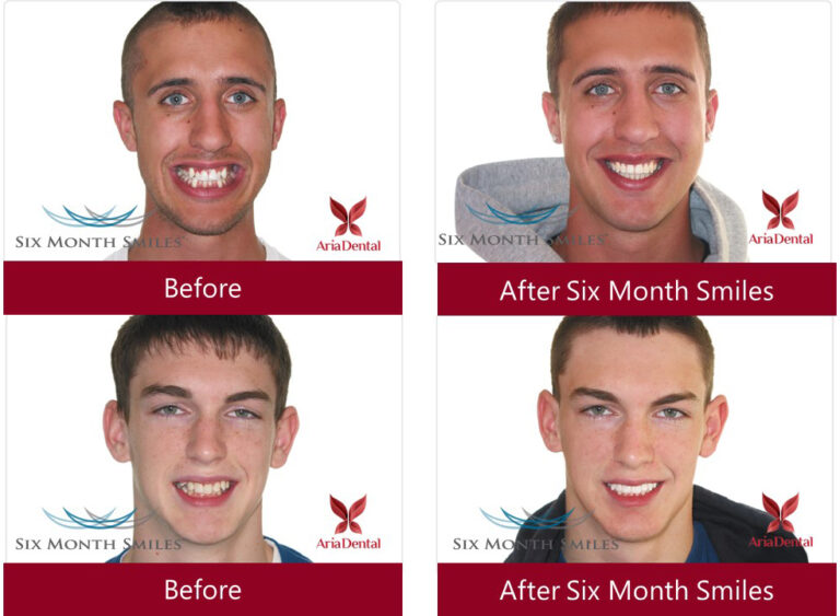 Six Month Smiles® | Aria Dental