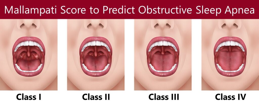 Sleep Disorder | Aria Dental