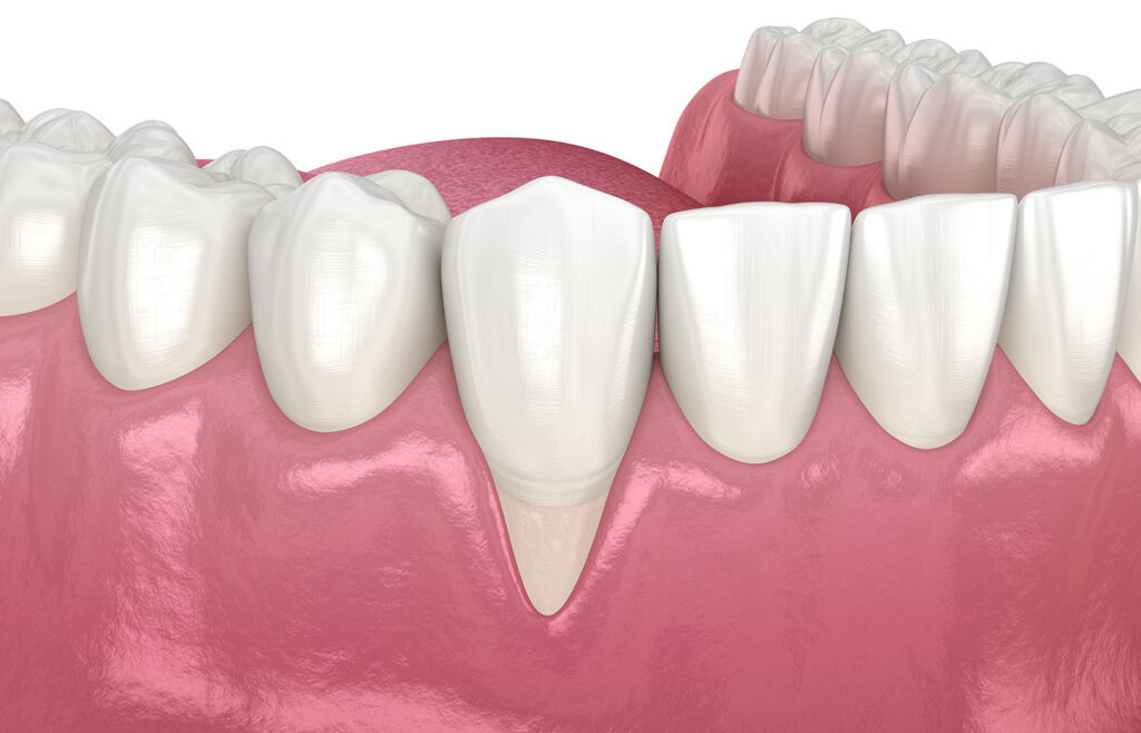 Gum Recession | Aria Dental