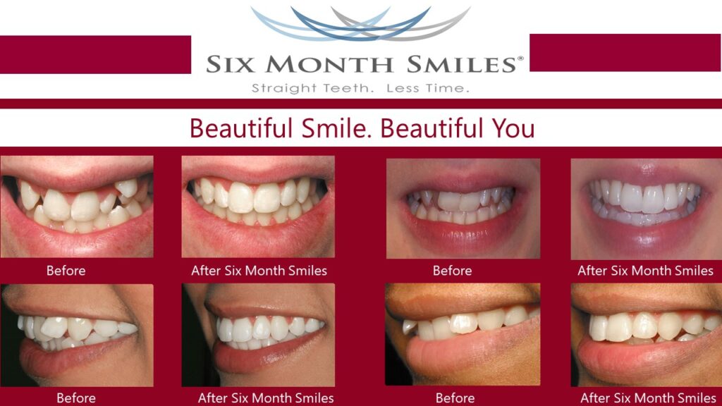 Six Month Smiles® | Aria Dental