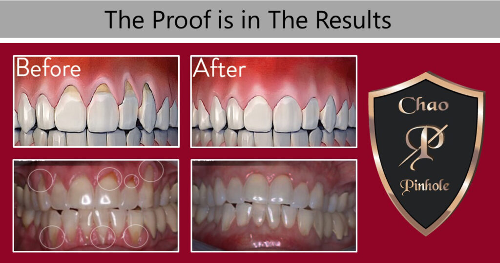Gum Recession | Aria Dental
