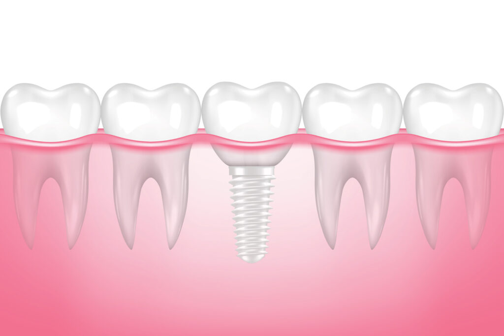 Is Zirconia Implant Really Metal-free & Biocompatible? | Aria Dental