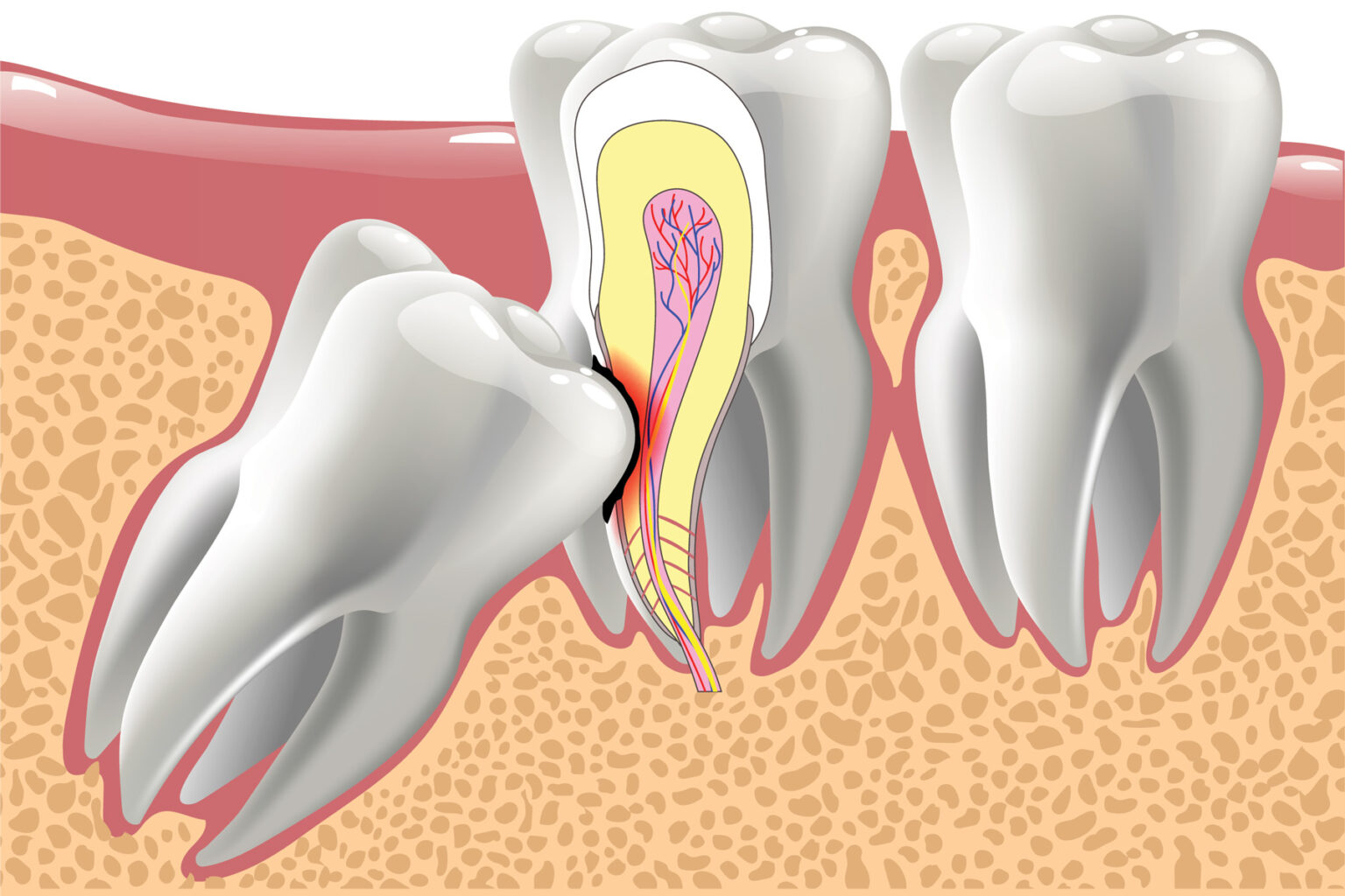 Reasons to Remove Impacted Wisdom Teeth In the Early Stage | Aria Dental