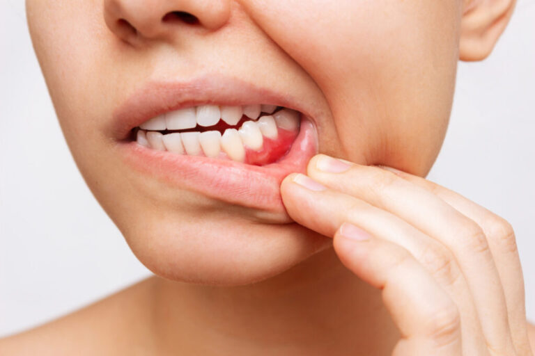 How to Reverse Gum Disease; An Easy Solution | Aria Dental