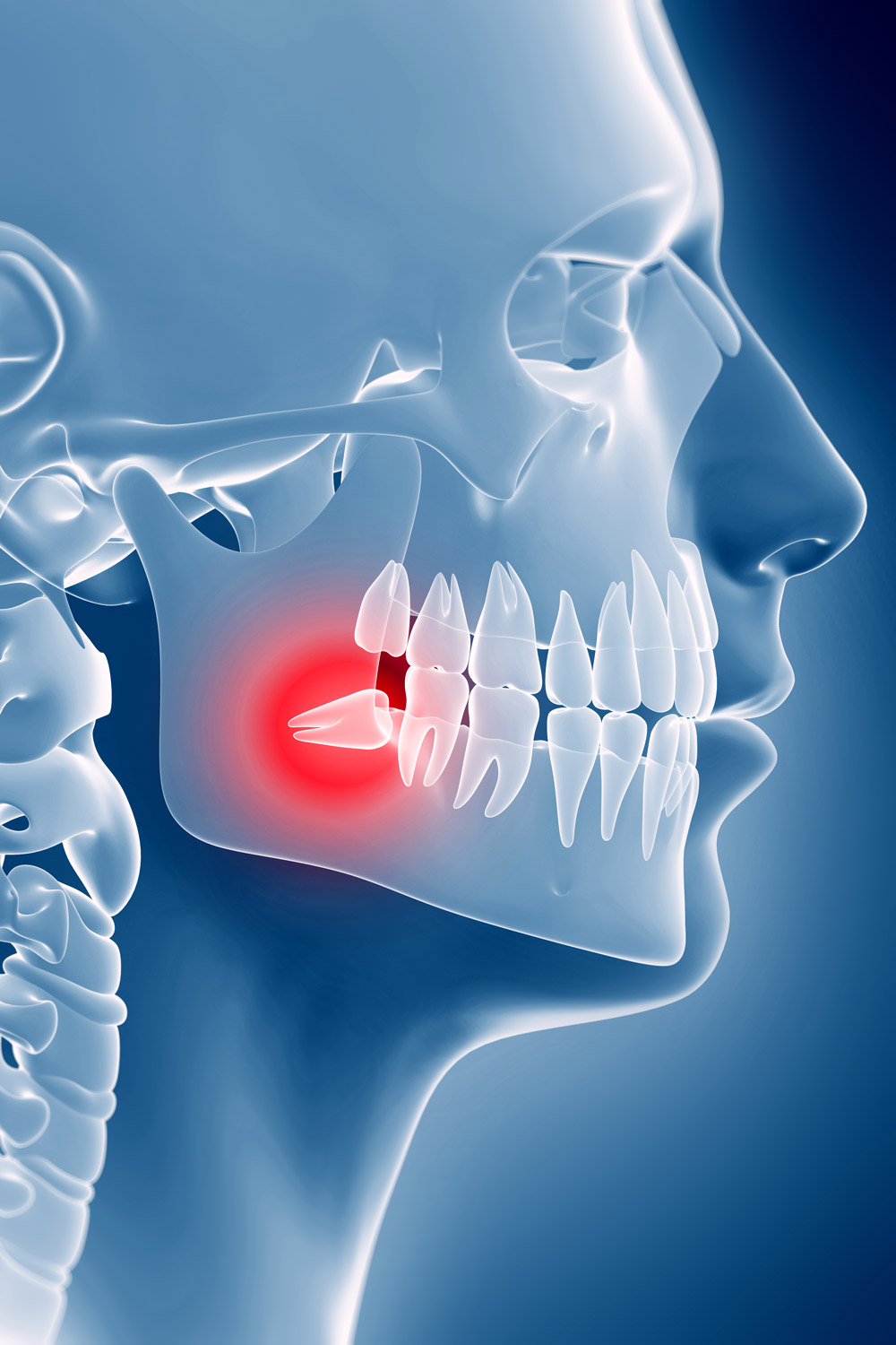 Prevent Jawbone Infection During Wisdom Teeth Extractions