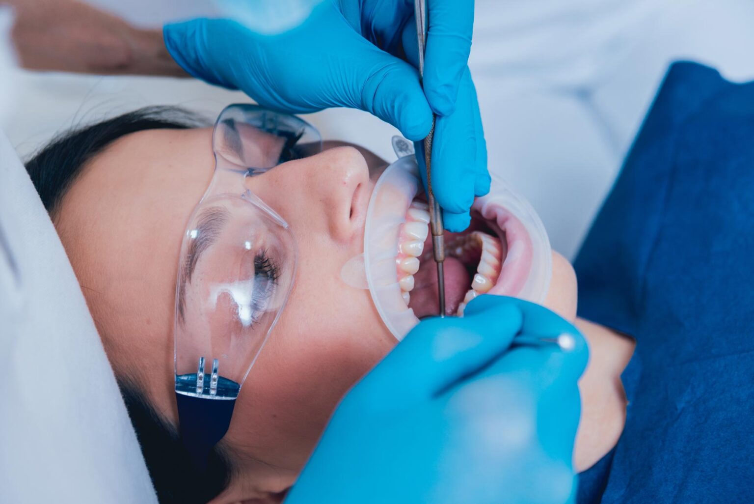 How to Avoid Root Canal? | Aria Dental