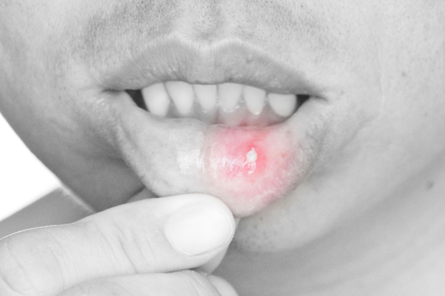 Blisters Inside Lip After Dental Procedure Infoupdate