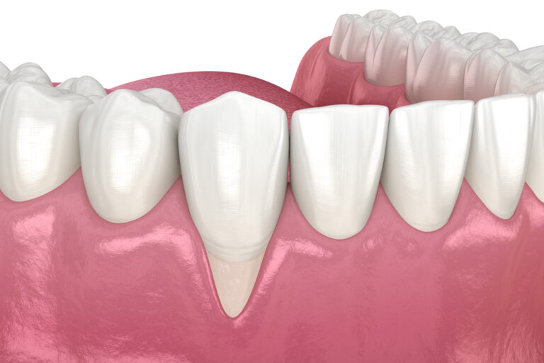 How to Stop Gum Recession? | Aria Dental