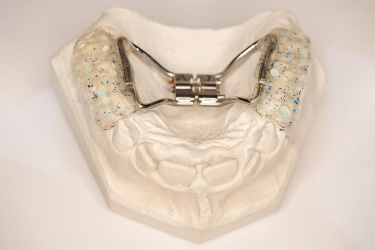 The Ultimate Guide for Palatal Expander | Aria Dental