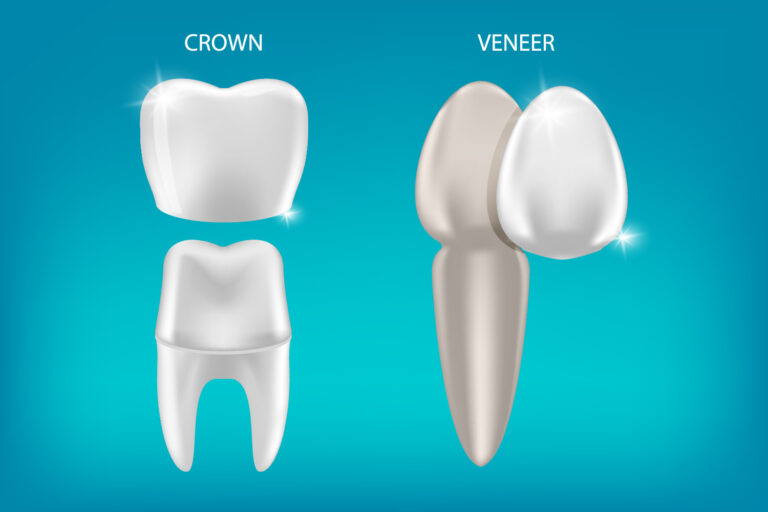 Crown vs. Veneer: Which One Do I Need Now? | Aria Dental