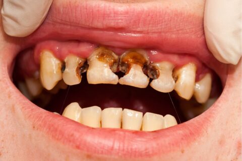 Cavity Between Teeth - Causes and Treatment Options | Aria Dental