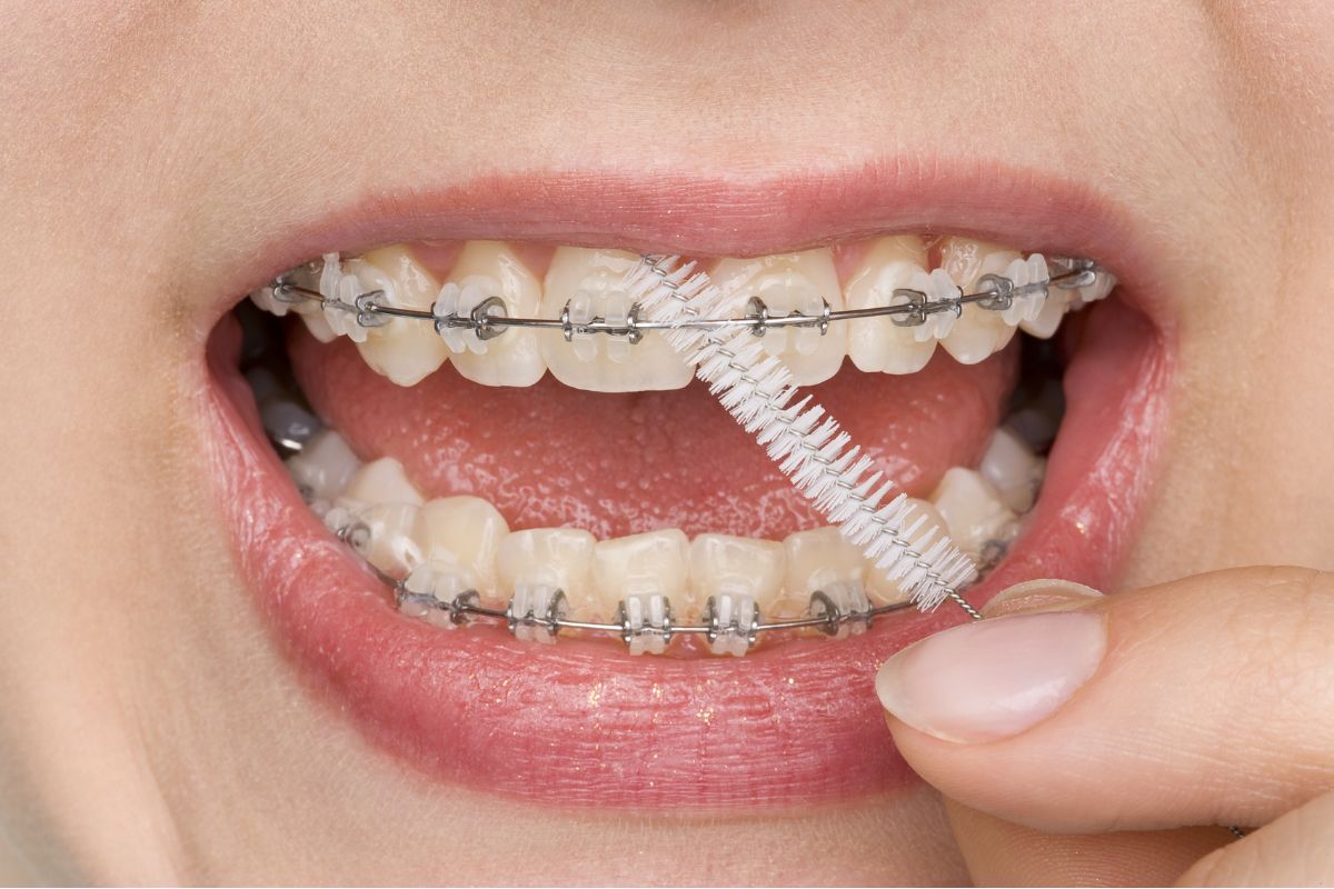 Flossing 101: How To Floss With Braces | Aria Dental