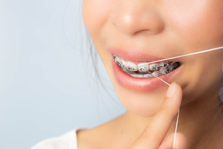 Flossing 101: How To Floss With Braces | Aria Dental