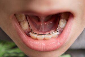 Spacers for Braces Guide: How They Work, Pain & More | Aria Dental