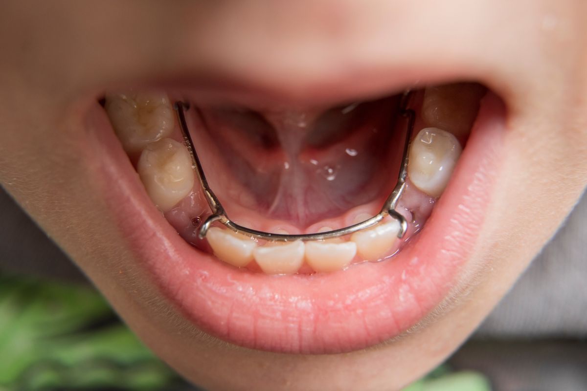 Spacers for Braces Guide: How They Work, Pain & More | Aria Dental
