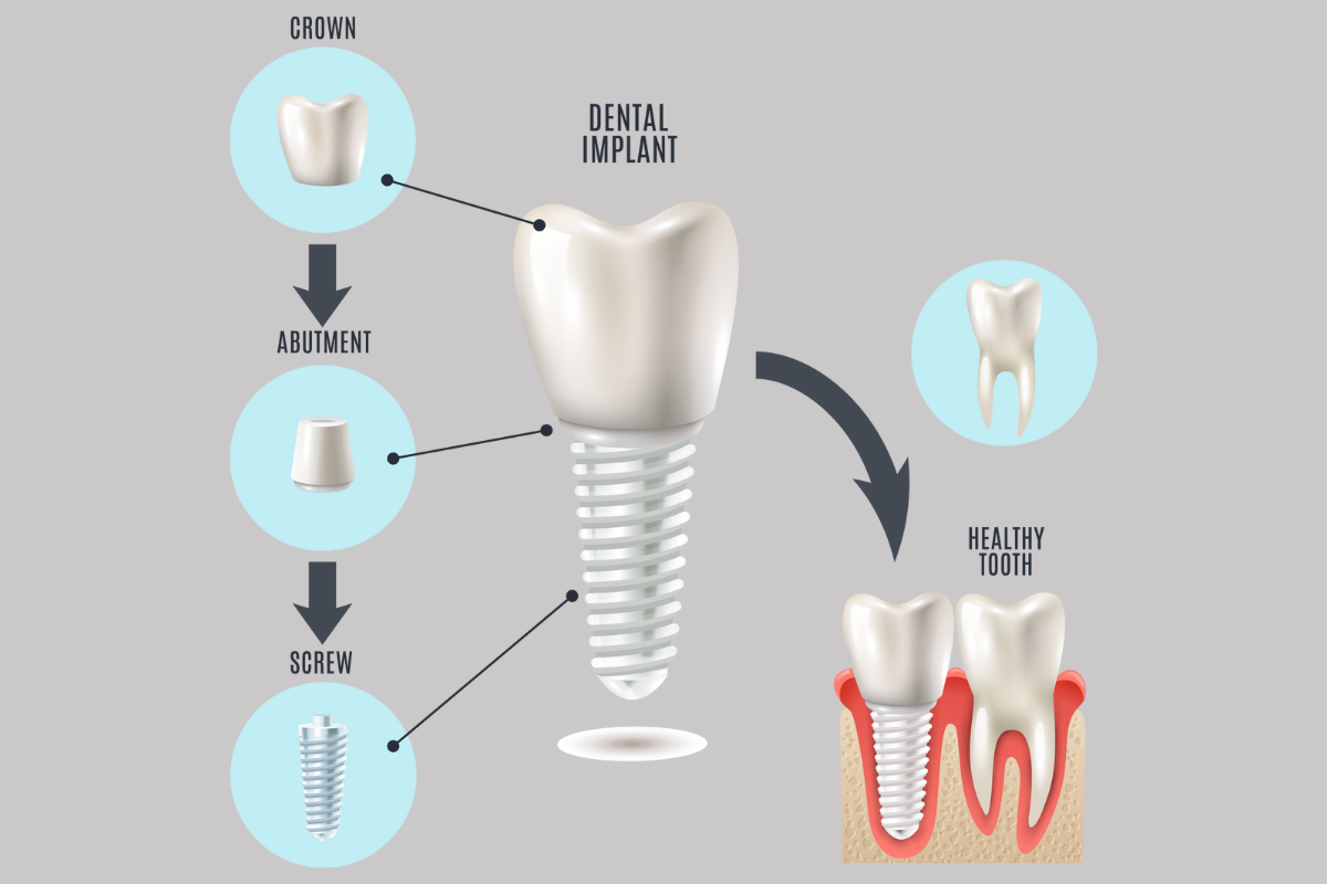 What Are The Different Types of Dental Implants? | Aria Dental