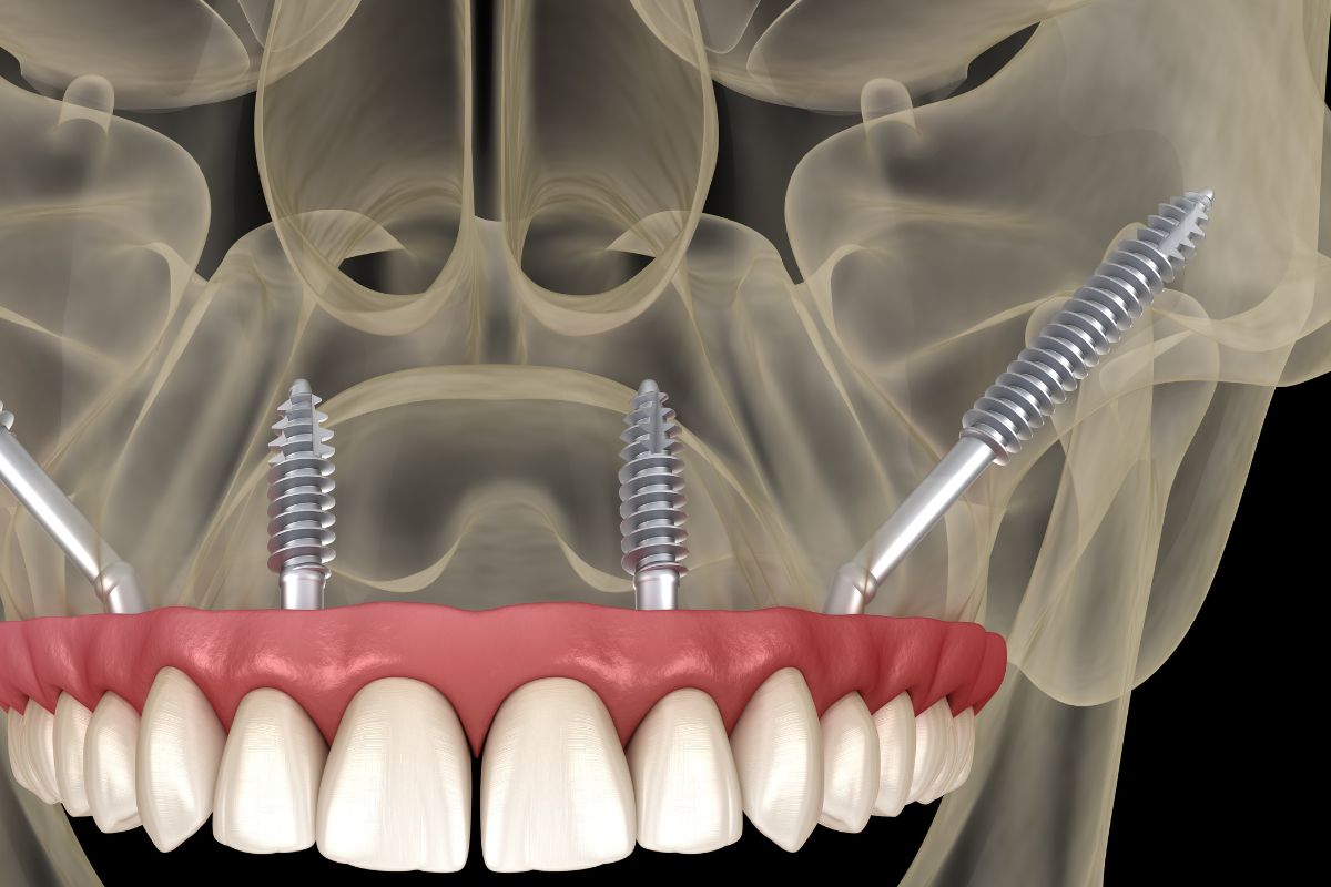 Zygomatic Implants, What You Need To Know | Aria Dental
