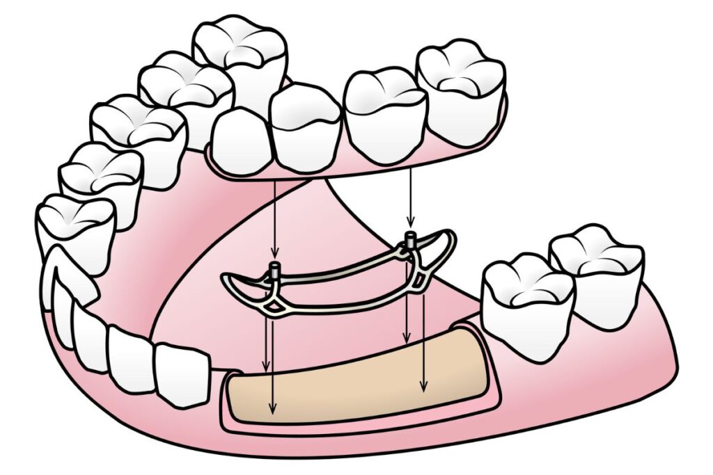 Subperiosteal Implants, A Comprehensive Guide | Aria Dental