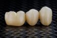 What Are Endosteal Implants? | Aria Dental