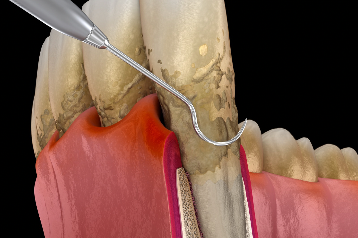 Who is a Periodontist? | Aria Dental