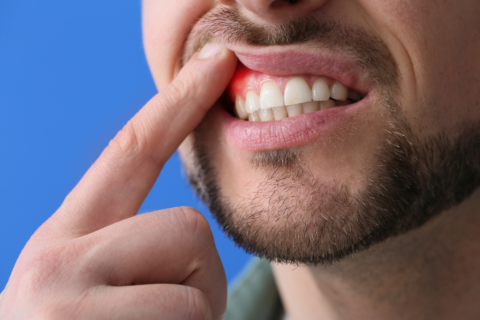 The 3 Stages of Periodontal Disease | Aria Dental
