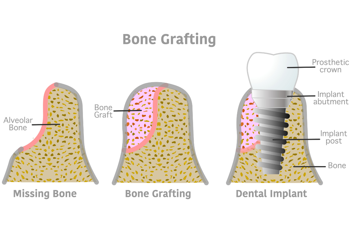 What is Dental Bone Graft? | Aria Dental