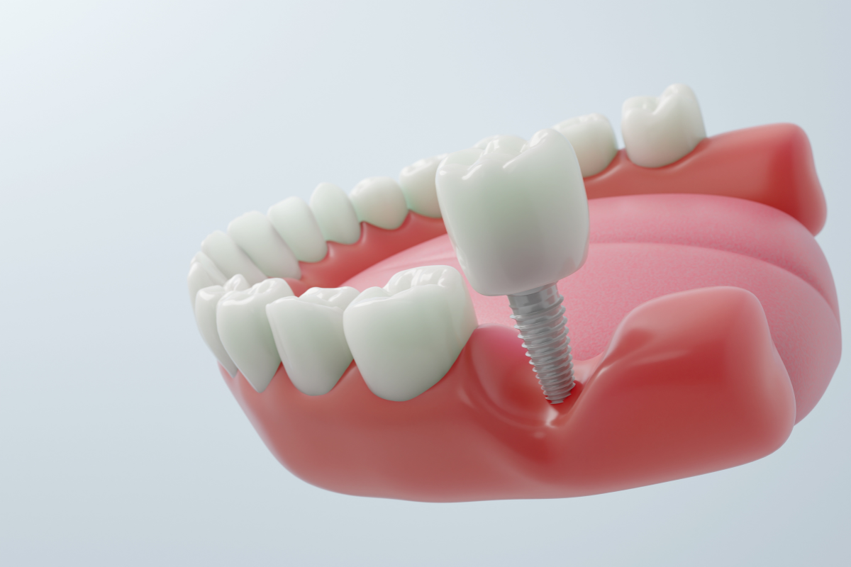 8 Signs That You Need Dental Implants and What They Mean | Aria Dental