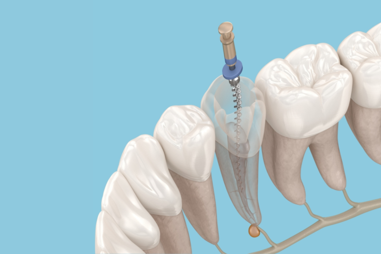 The Hidden Risks of Root Canal Therapy: What Most Patients Don’t Know ...