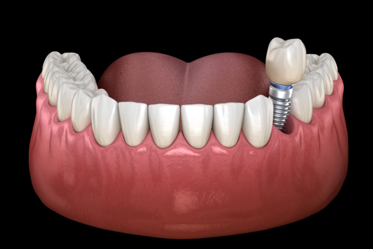 What Are Screwless Dental Implants? A Complete Guide to This Modern ...